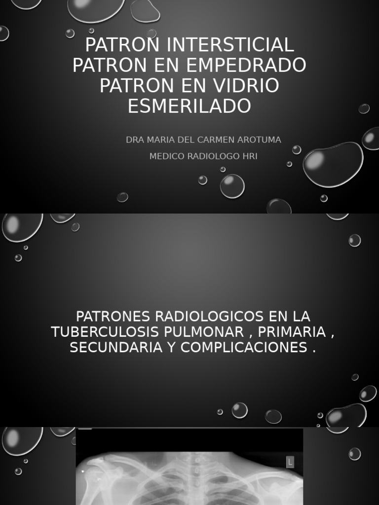 PATRON INTERSTICIAL | PDF