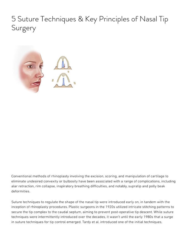 5 Suture Techniques & Key Principles of Nasal Tip Surgery 2 | PDF ...