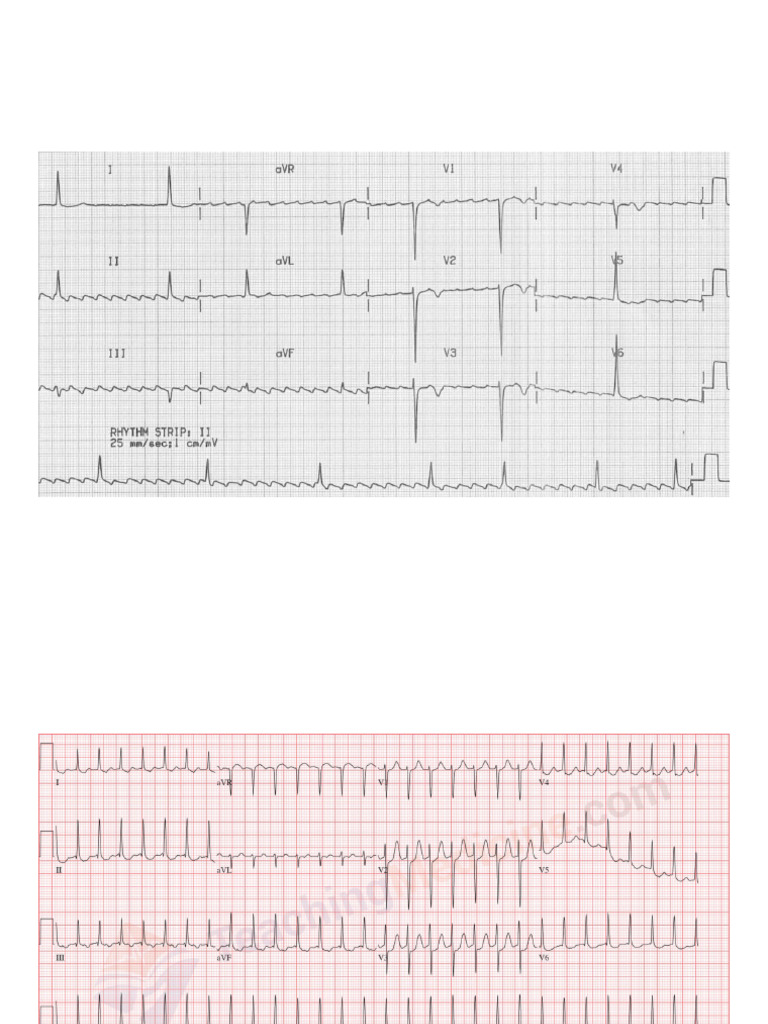 ECG PPT | PDF