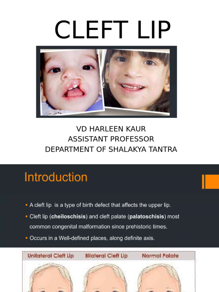 Cleft Lip | PDF