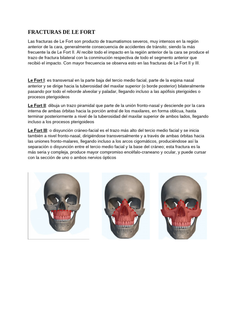 Clasificación de Fracturas de Le Fort | PDF