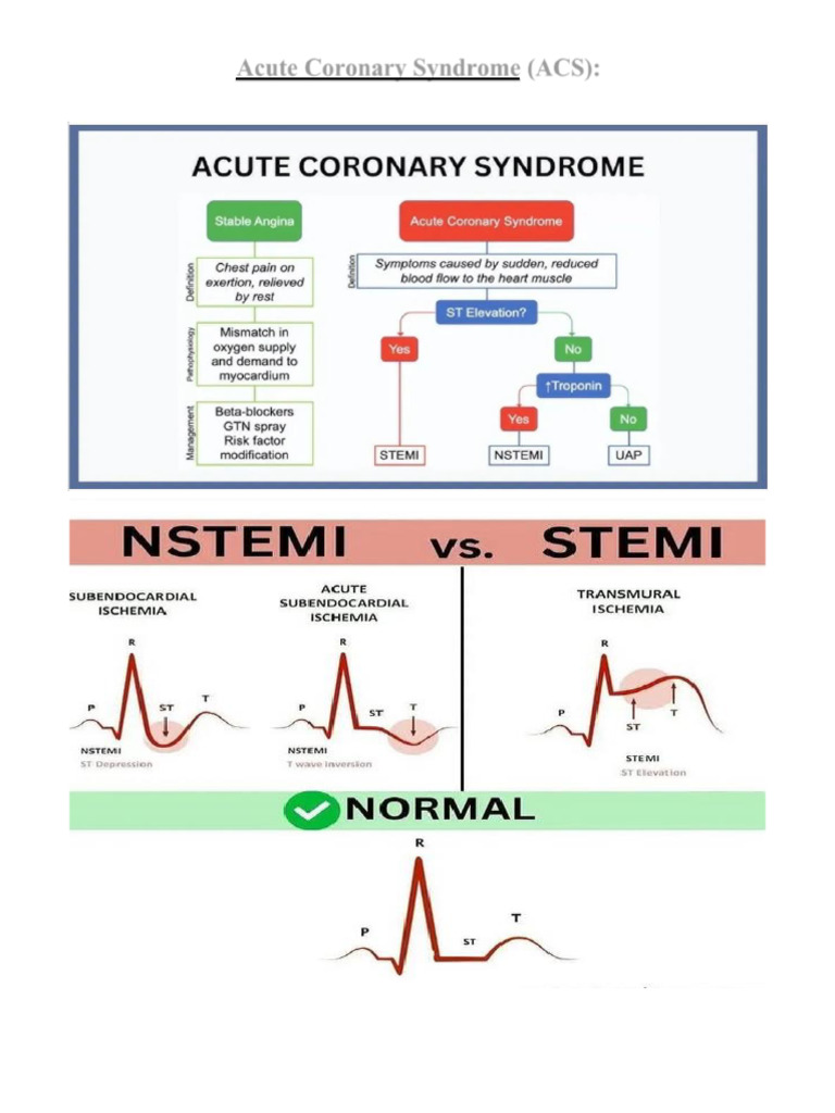 Acute Coronary Syndrome (ACS) | PDF | Myocardial Infarction ...