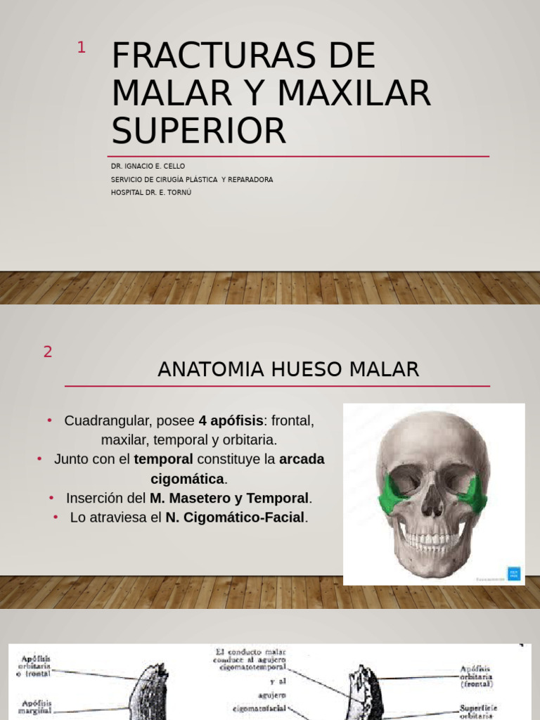Fractura Malar y Maxilar | PDF | Cabeza y cuello humanos | Anatomía humana