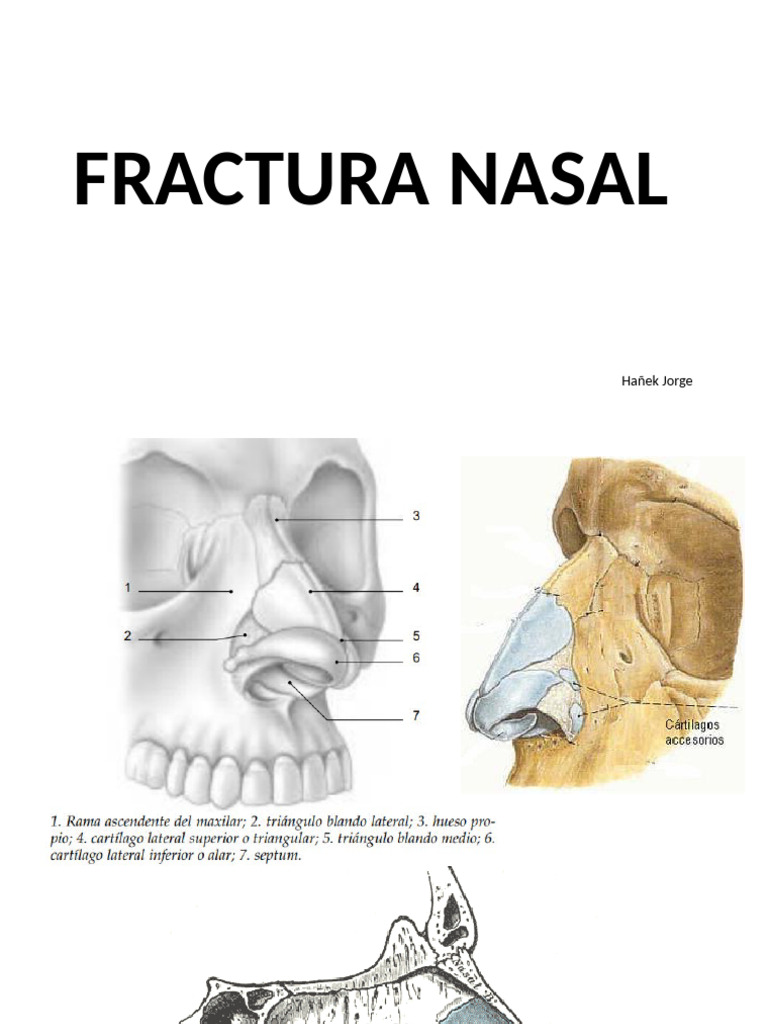 Guía Completa sobre Fractura Nasal | PDF | Nariz humana | Cabeza y ...