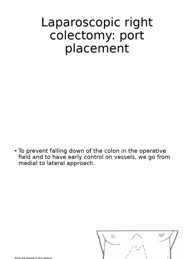 Laparoscopic Right Colectomy Port Placement | PDF
