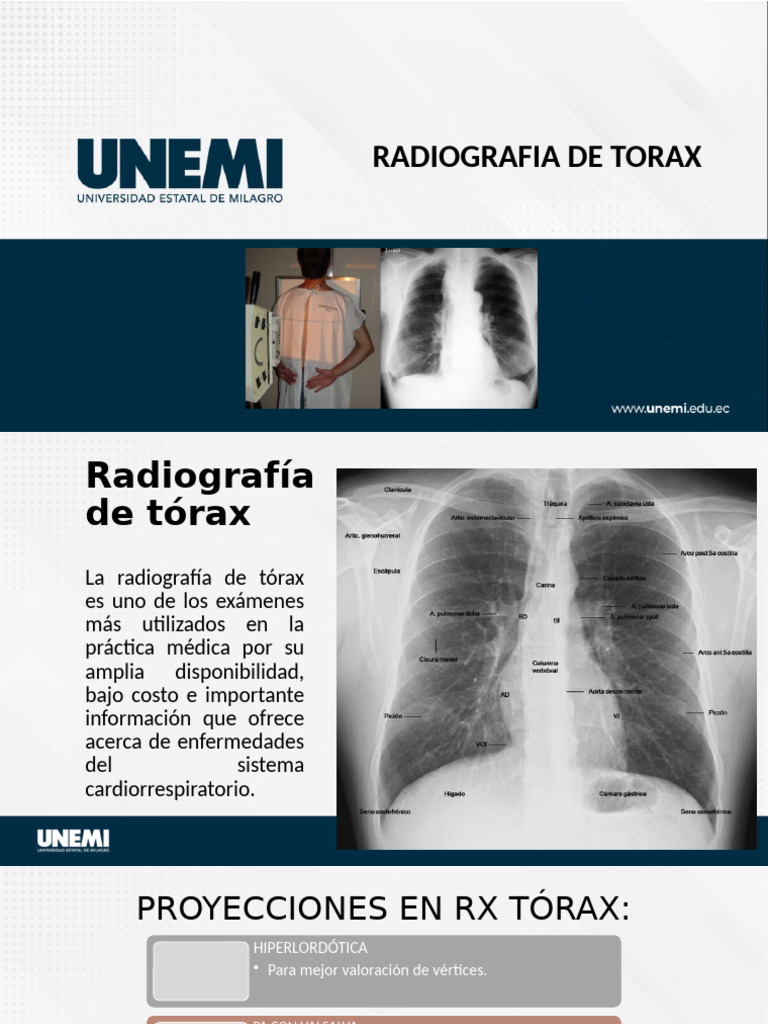 Radiografía de Tórax: Interpretación y Proyecciones | PDF | Tórax ...