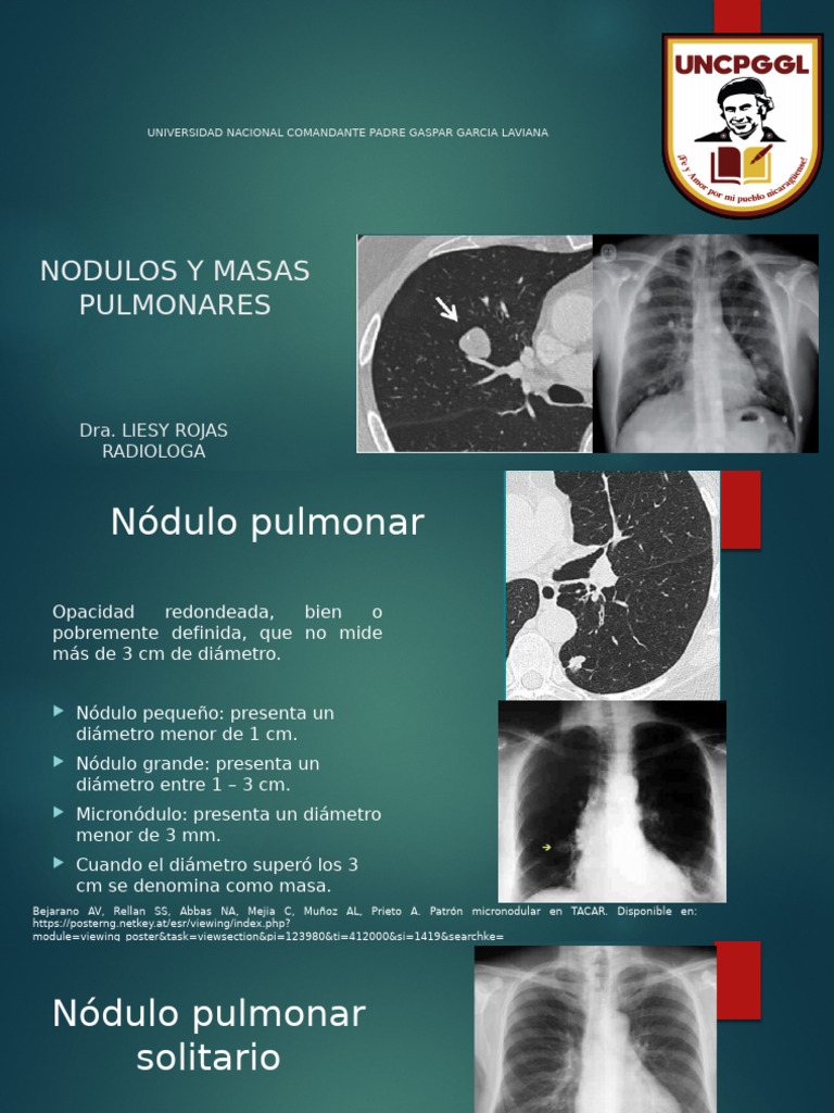 Nódulos y masas pulmonares: diagnóstico y características | PDF ...