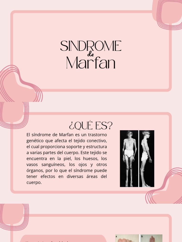 Síndrome de marfan .pdf | PDF | Enfermedades y trastornos | Enfermedades y trastornos humanos