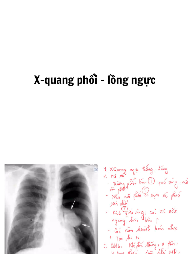 X-quang tim - pho%CC%82%CC%89i | PDF