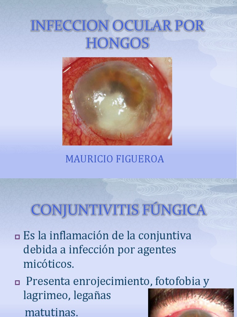 Infeccion Ocular Por Hongos | Ojo humano | Hongo