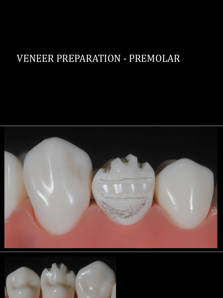 Premolar Veneer Prep | PDF