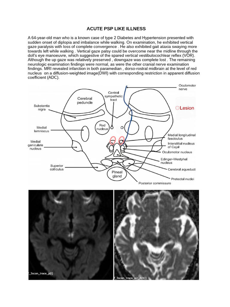 vertical gaze palsy (1) | PDF