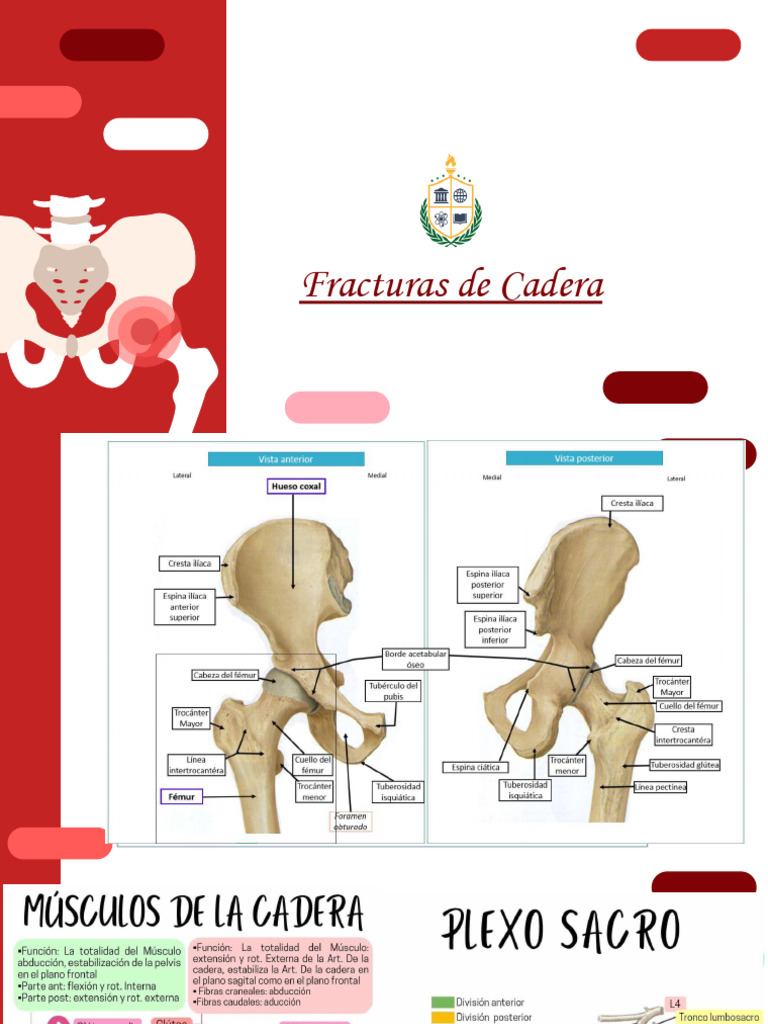 Clasificación y tratamiento de fracturas de cadera | PDF | Pelvis ...