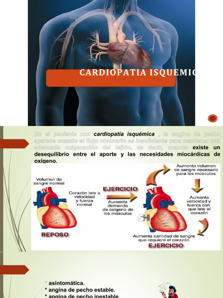 Cardiopatia Izquemica | PDF | Infarto de miocardio | Medicina CLINICA