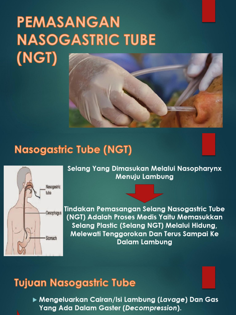 Ppt 5 Pemasangan Ngt | PDF