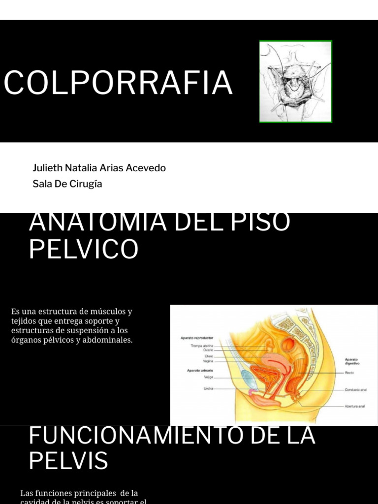 Exposición Colporrafia | PDF | Pelvis | Vagina