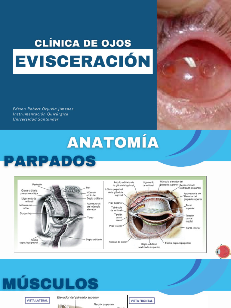 Evisceración ocular: técnica y complicaciones | PDF | Ojo ...