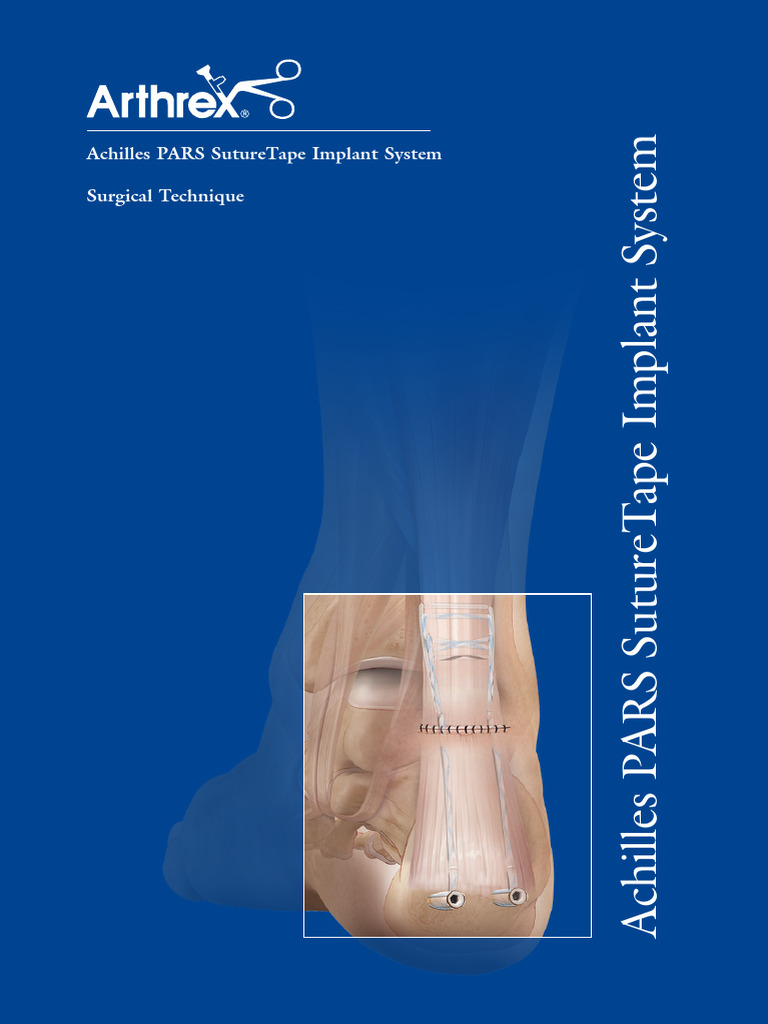 Achilles PARS SutureTape Implant System | PDF | Surgical Suture | Surgery