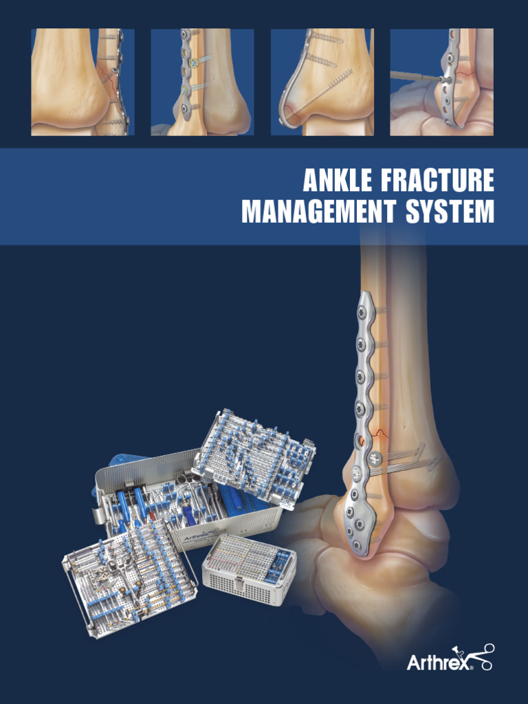 Arthrex Ankle Fracture Management System | PDF | Screw | Drill