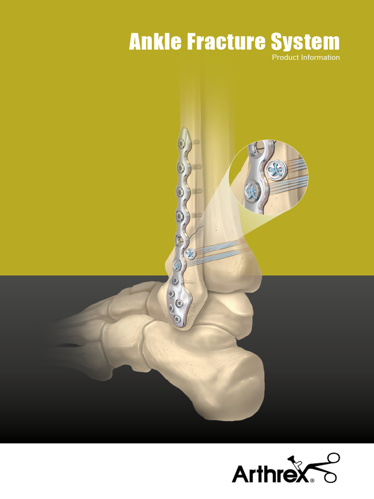 Ankle Fracture System | PDF | Screw | Ankle