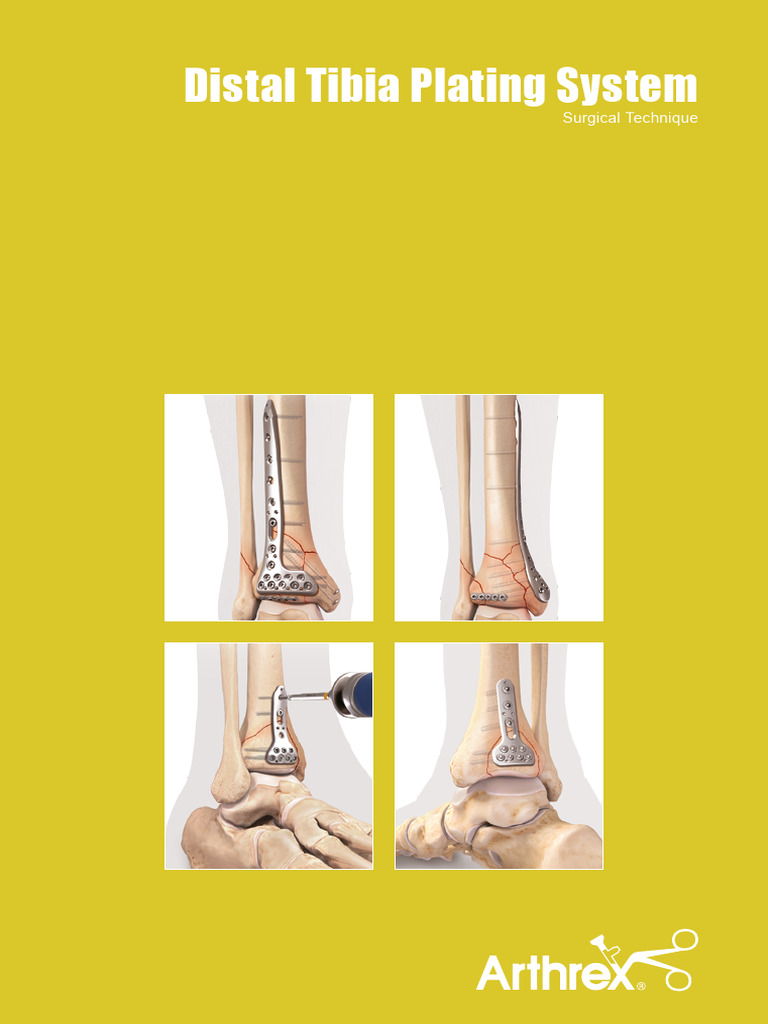 Distal Tibia Plating System | PDF | Ankle | Anatomical Terms Of Location