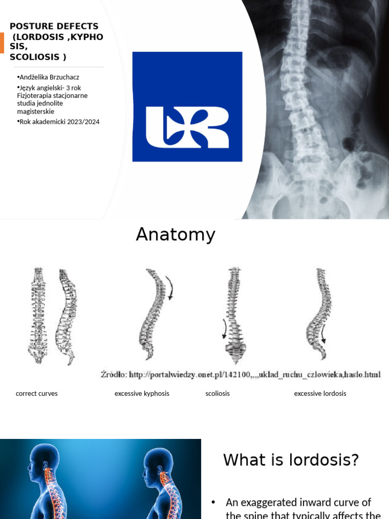 Posture Defects - Andżelika Brzuchacz | PDF | Vertebral Column | Scoliosis