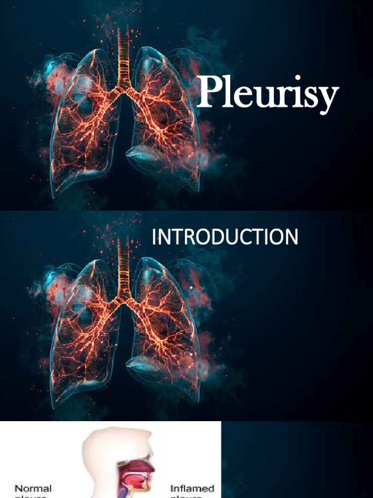 Pleurisy | PDF