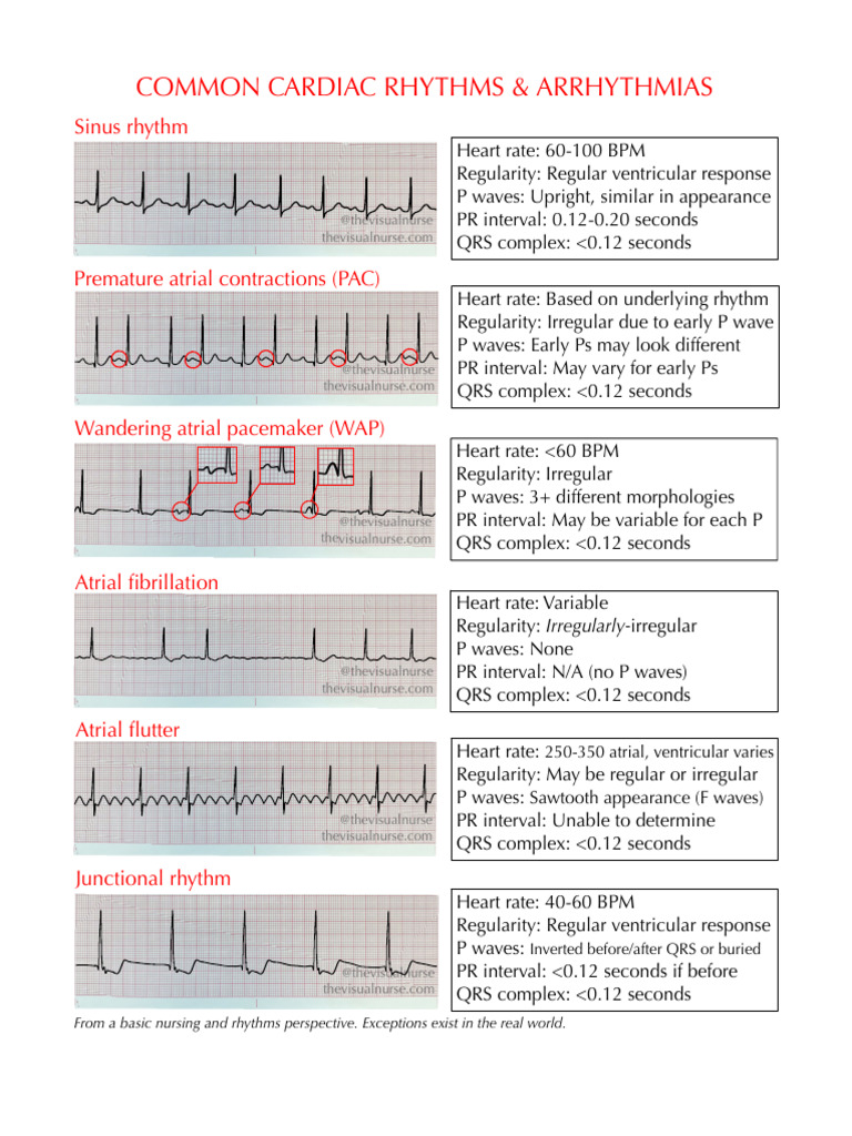 Common Cardiac Rhythms and Arrhythmias | PDF | Heart | Cardiac ...