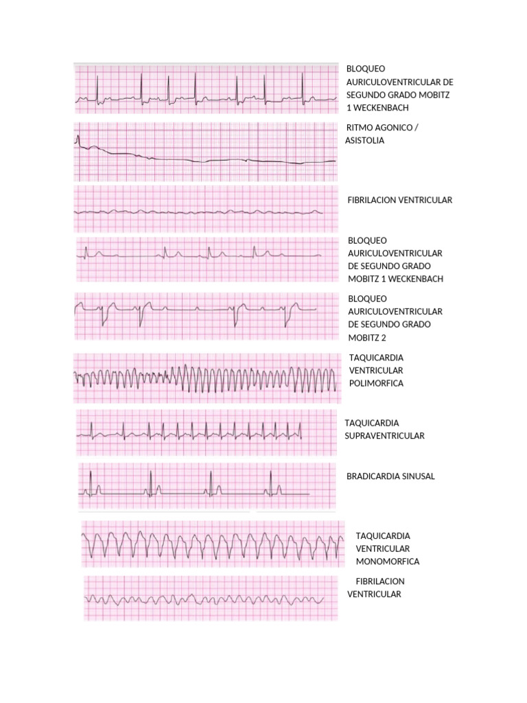 Acls Ekg | PDF