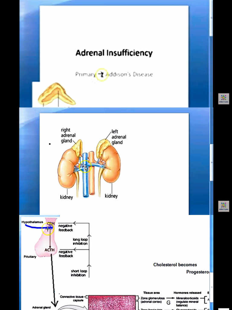 Adrenal Insufficiency (Addison DZ) | PDF