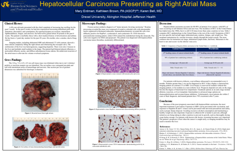Drexel Patha Poster Hepatocellular Carcinoma Presenting | PDF ...