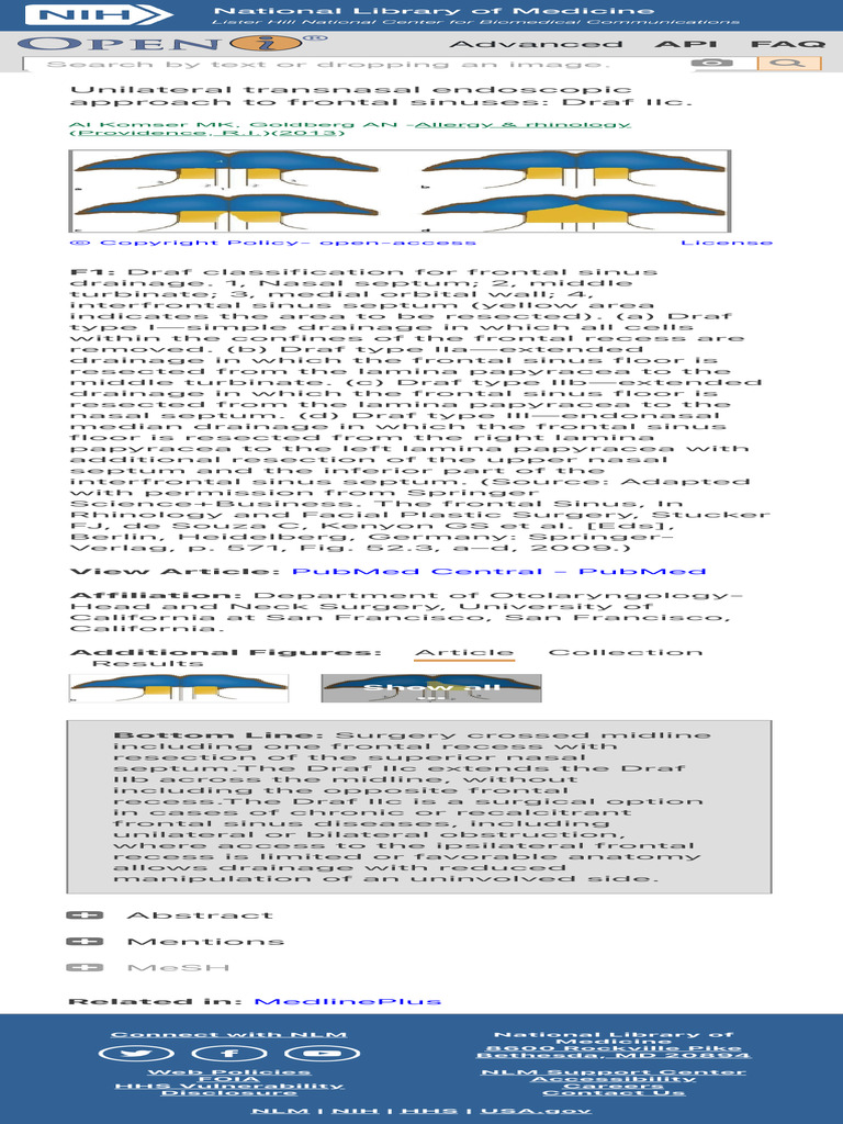 Draf Classification For Frontal Sinus Drainage. 1, Nasa Open-I | PDF ...