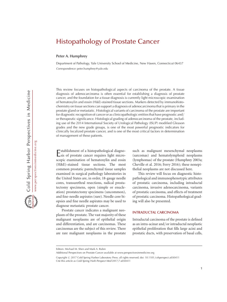 Prostate Cancer Histopathology Overview | PDF | Adenocarcinoma | Carcinoma