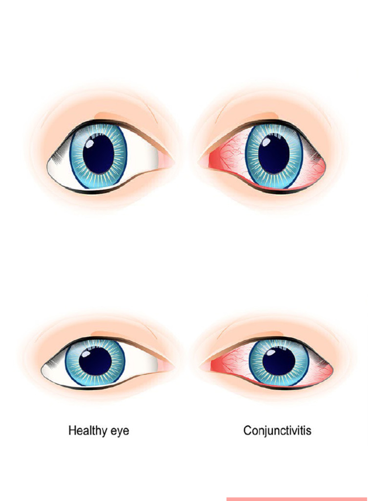 Conjuctivitis 4 | PDF