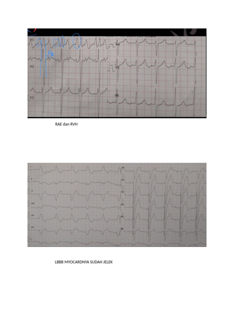Ecg Emergency | PDF