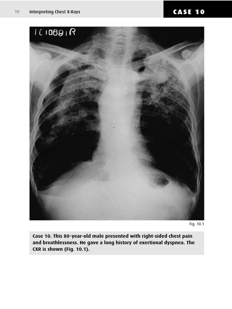 Chest X-Ray Interpretation Cases | PDF
