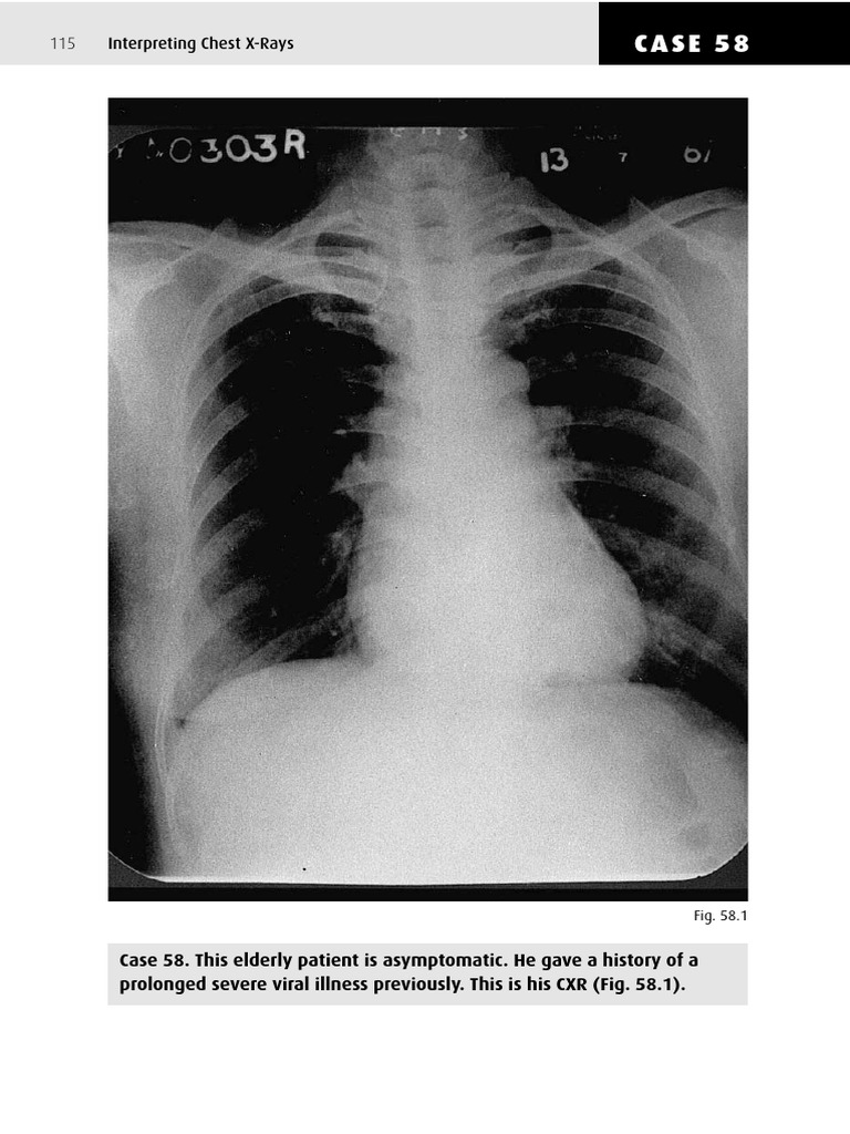 Interpreting Chest X-Rays Illustrated With 100 Cases 5 | PDF