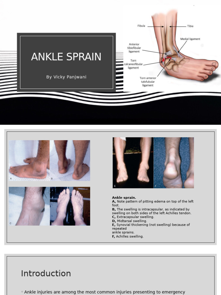 Ankle Sprain | PDF | Ankle | Foot