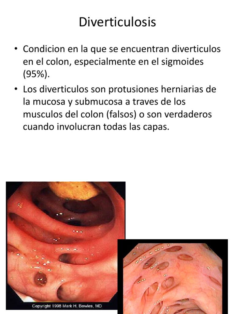 diverticulosis | Enfermedades y trastornos | Especialidades Medicas