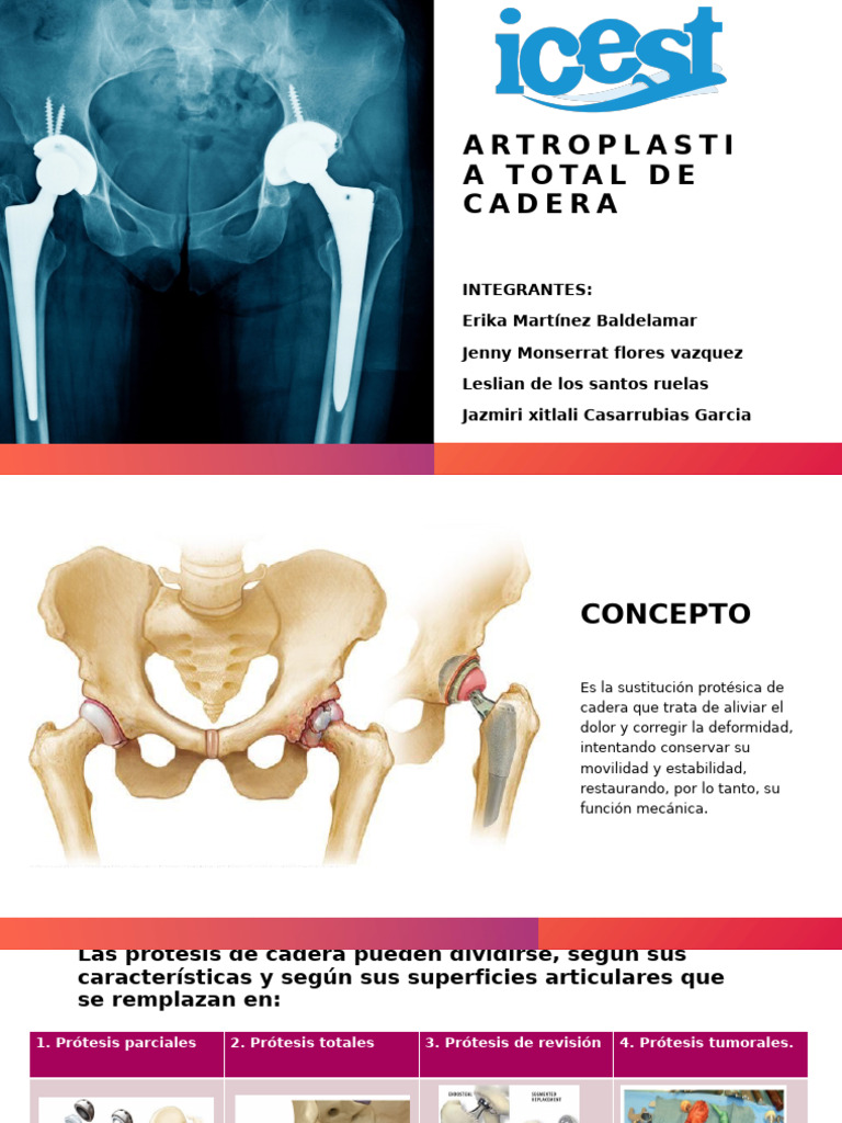 Artroplastia Total de Cadera | PDF | Articulación | Especialidades Medicas