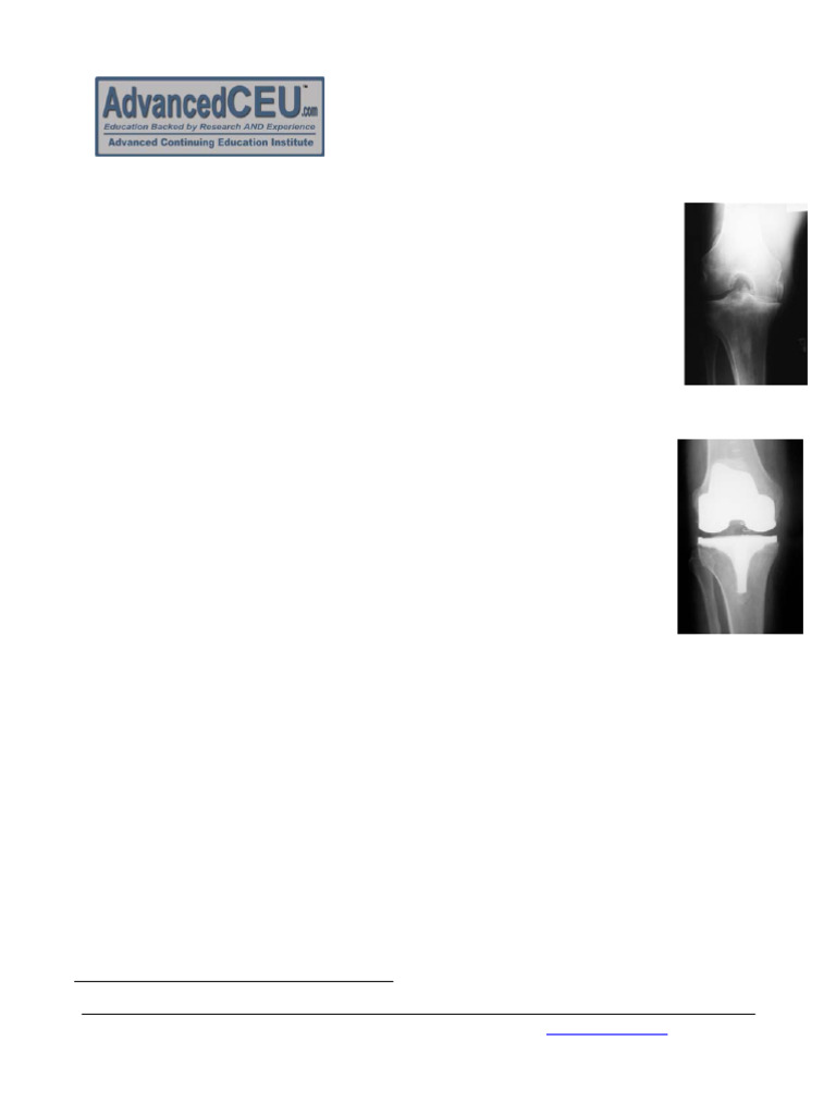 Preoperative Total Knee Replacement | PDF | Knee | Musculoskeletal System