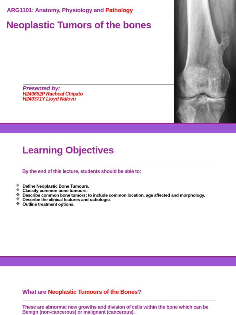 Neoplastic Bone Tumors Overview | PDF | Benign Tumor | Neoplasms