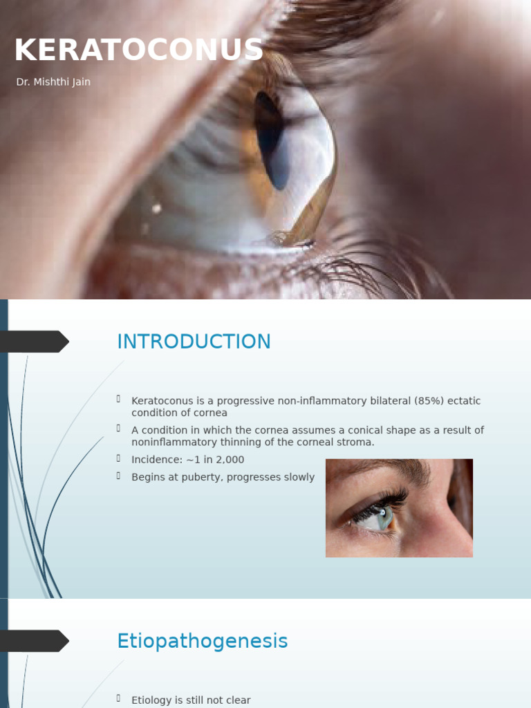 Keratoconus 1 | PDF