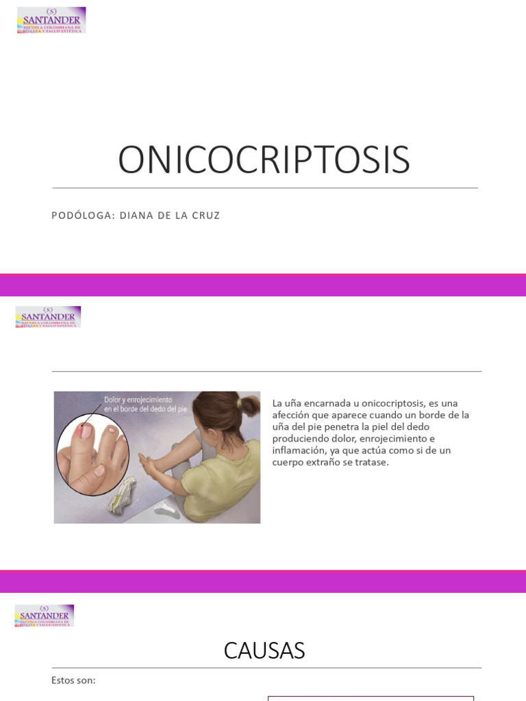 ONICOCRIPTOSIS | PDF | Clavo (anatomía) | Anestesia