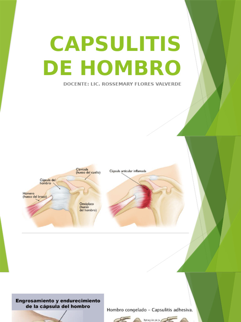 Causas y síntomas de capsulitis de hombro | PDF