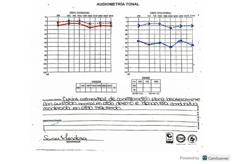 Audiometría Tonal | PDF