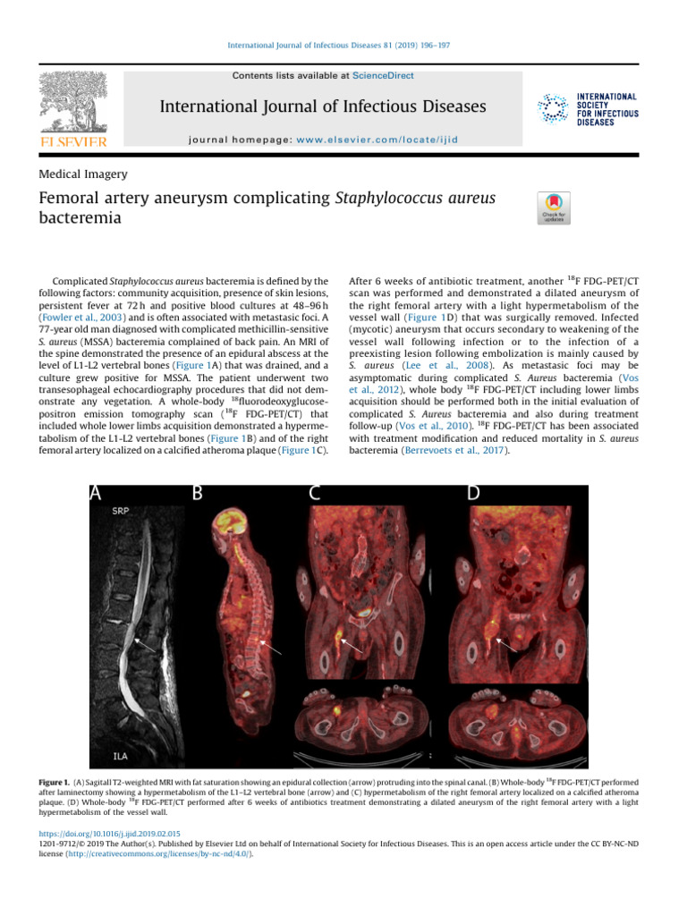 Femoral Artery Aneurysm Complicating em Staphyloc | PDF ...