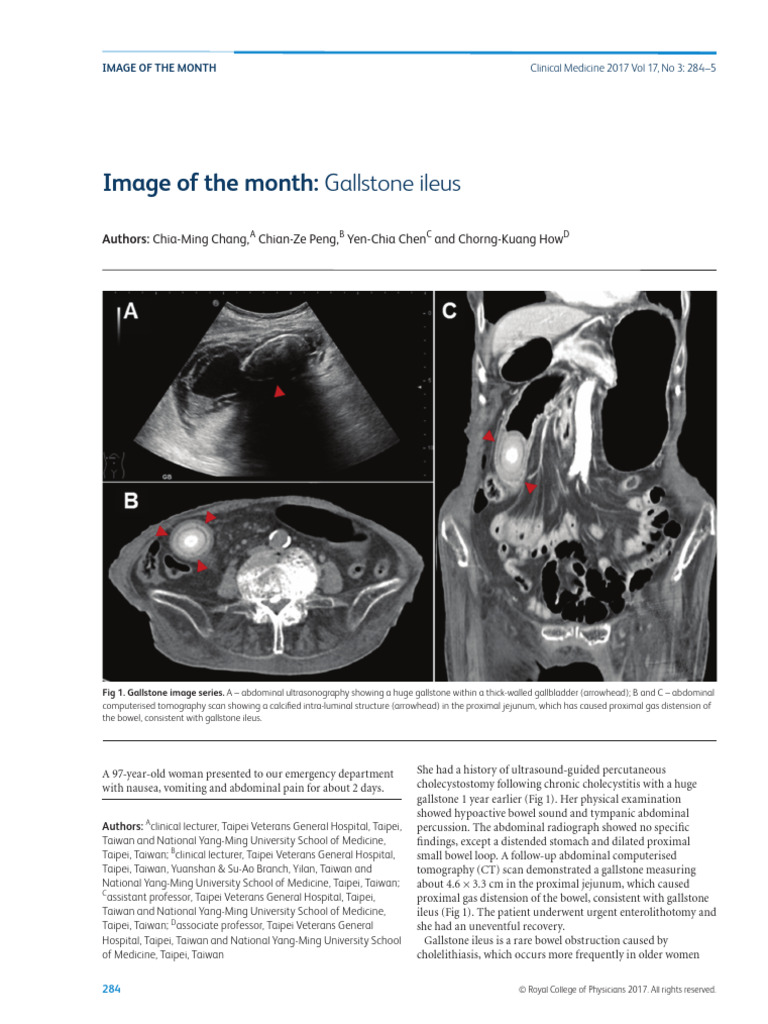 Image of The Month Gallstone Ileus - 2017 - Clinical Medicine | PDF ...