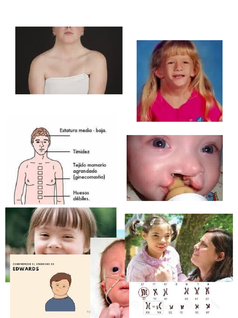 Anomalías Cromosómicas | PDF