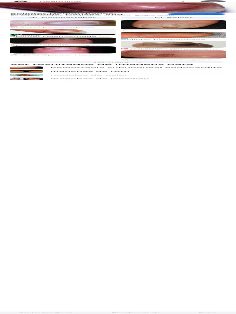 Hemorragia Splinter - Pesquisa Google | PDF